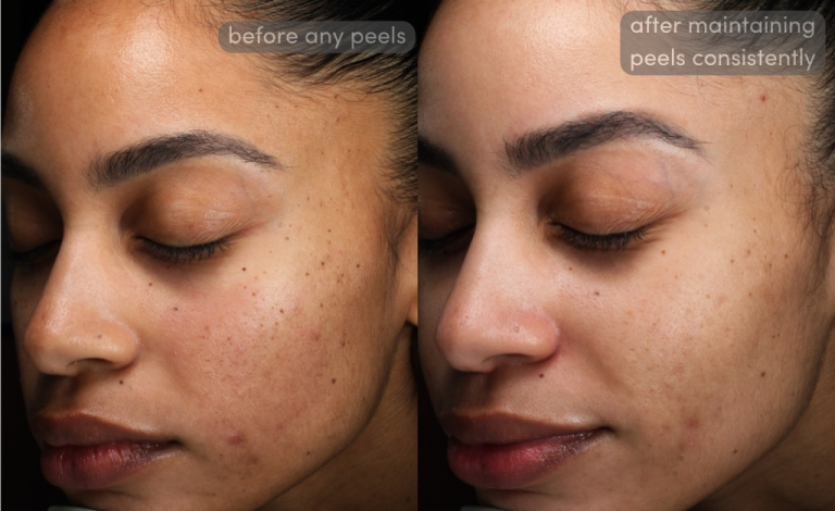 PODCAST: Patient Destiny - Chemical Peels Saved My Skin & Self Esteem ...